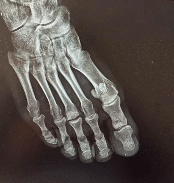 Ayak Başparmağı Distal Falanks Kırığı: Tedavi ve Cerrahi Endikasyonlar ...