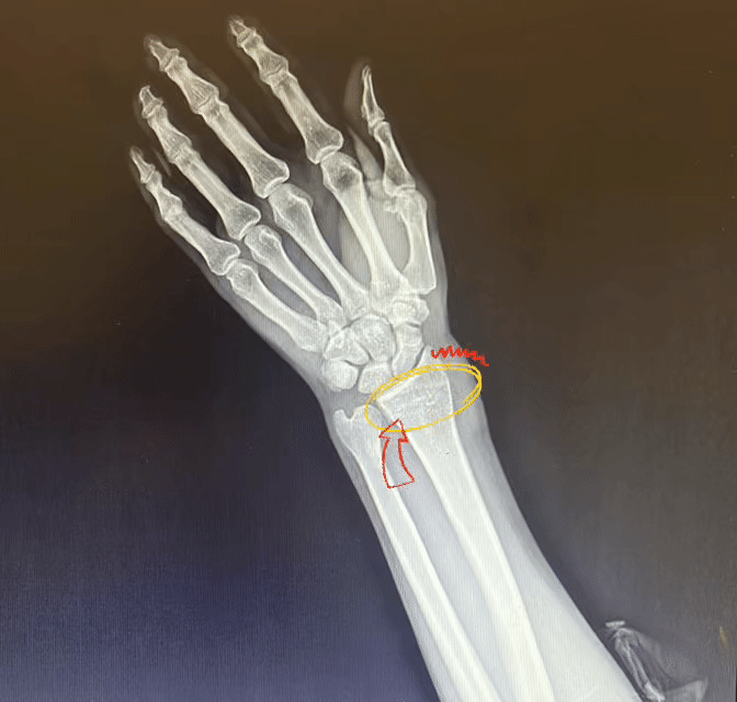 Distal Radius Kırıkları: Tanı, Tedavi ve Ortopedi Konsültasyonu - Acil ...