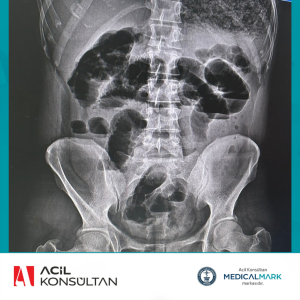 İleus: Acil Yaklaşım - Acil Konsültan
