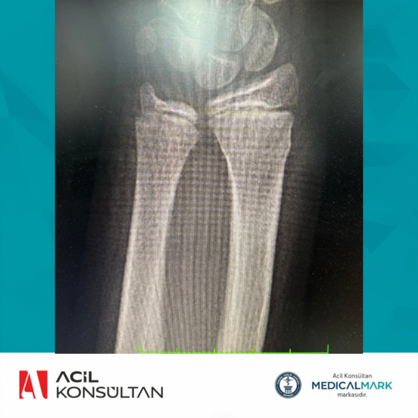 Çocuklarda Distal Radius Torus Kırığı - Acil Konsültan